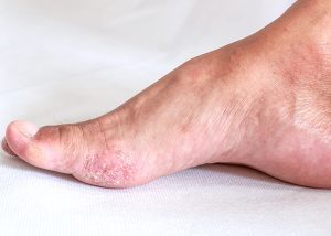 Fungal Infections - Belle Meade Medical